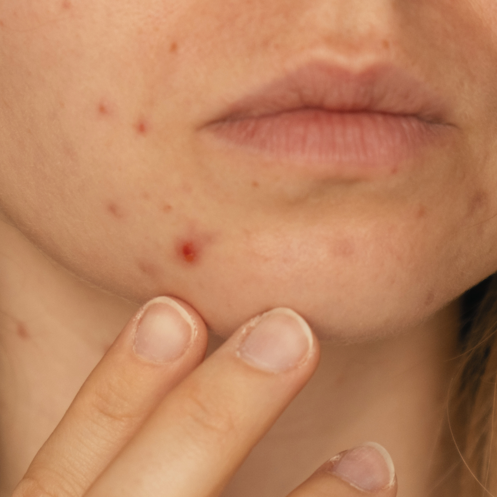 How to clear up acne with natural ingredients